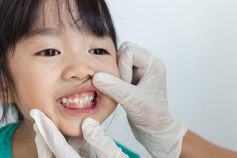What Shark Teeth Means for a Child's Oral Health | Kenmore, WA ...